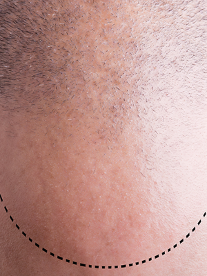 Penyebab Kebotakan pada Pria, Berikut Solusinya