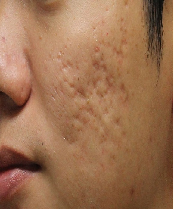 cara menghilangkan bopeng di wajah dengan perawatan yang tepat